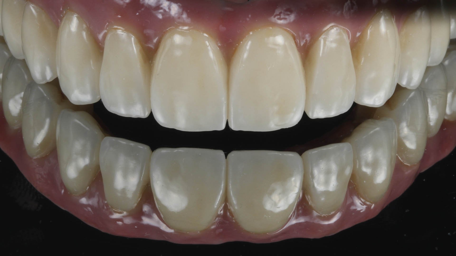 Prótesis Dental Híbrida sobre implantes | Dental Designer 3D